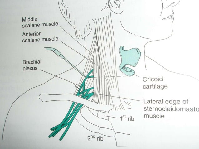 Peripheral Nerve Block Part 2 | PPTX | Death, Injury, or Military ...