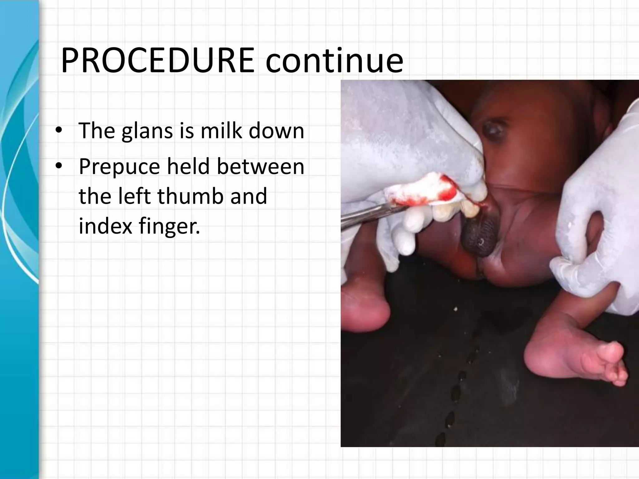 PAUL'S CIRCUMCISION | PPTX | Sexual Health | Diseases and Conditions