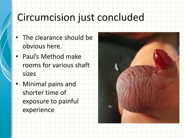 PAUL'S CIRCUMCISION | PPTX | Sexual Health | Diseases and Conditions