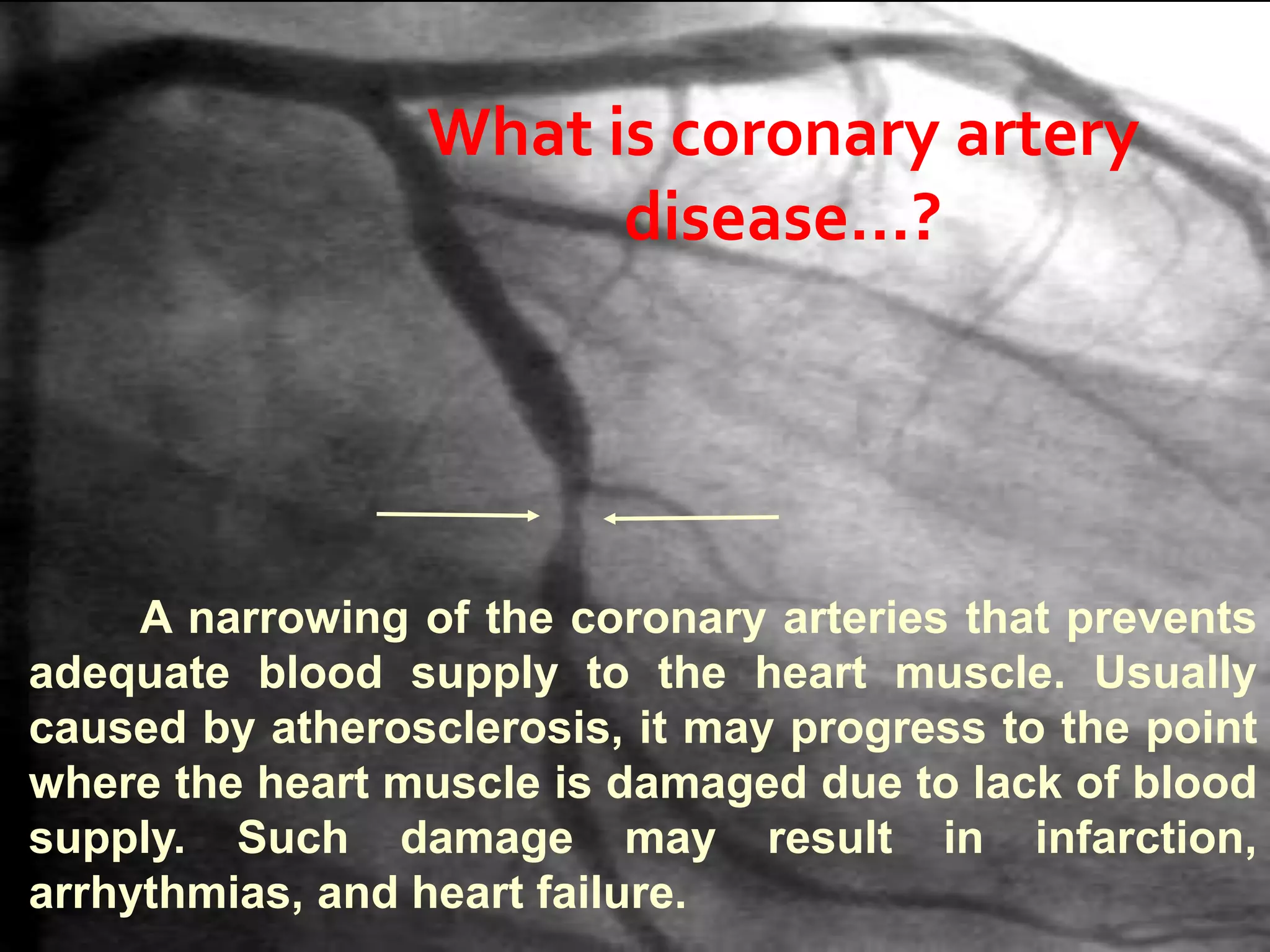 CORONARY ARTERY DISEASES | PPTX