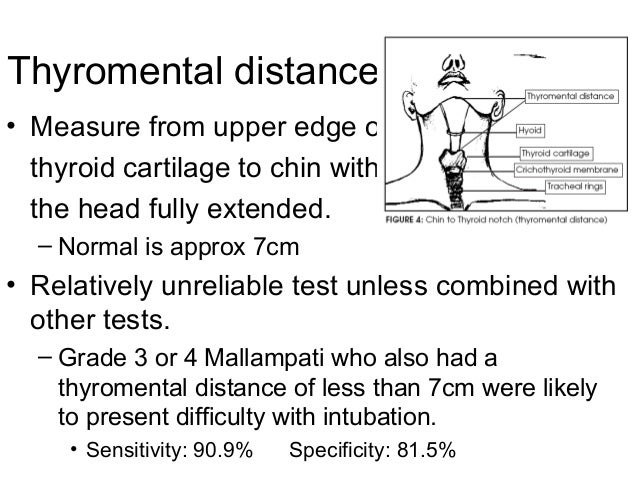 Thyromental Distance