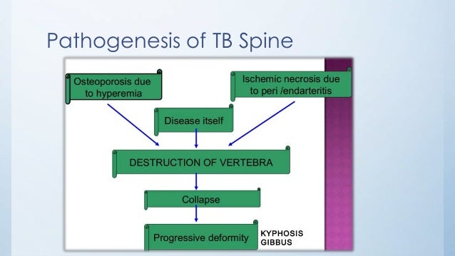 Tuberculosis of spine