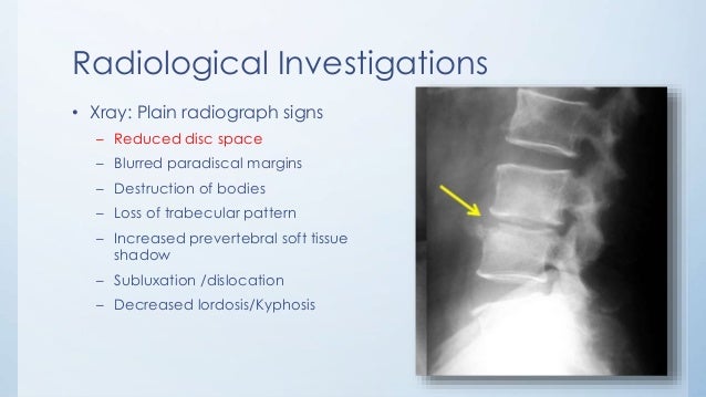 Tuberculosis of spine