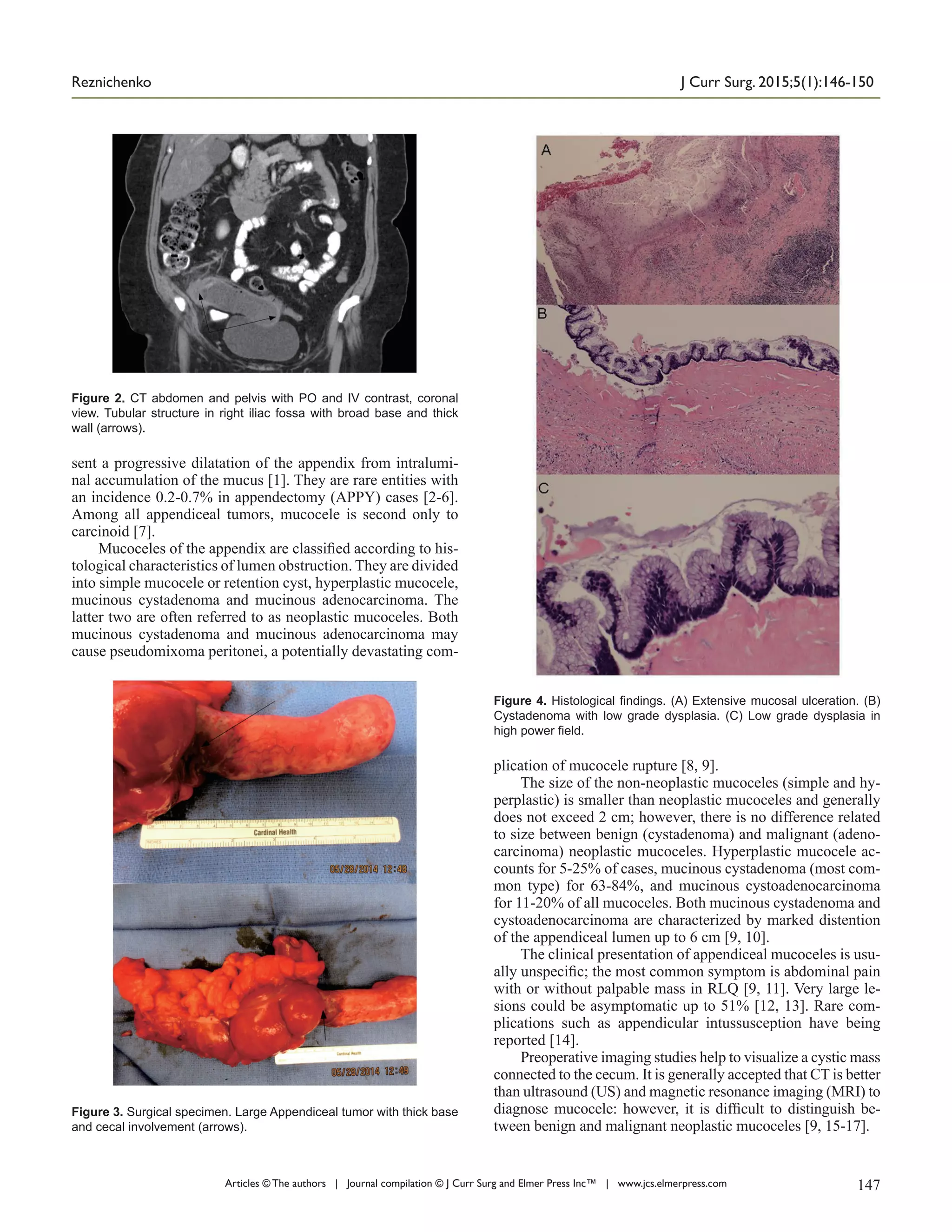 265-1738-1-PB APPENDIX CYSTADENOMA | PDF | Digestive Disorders ...