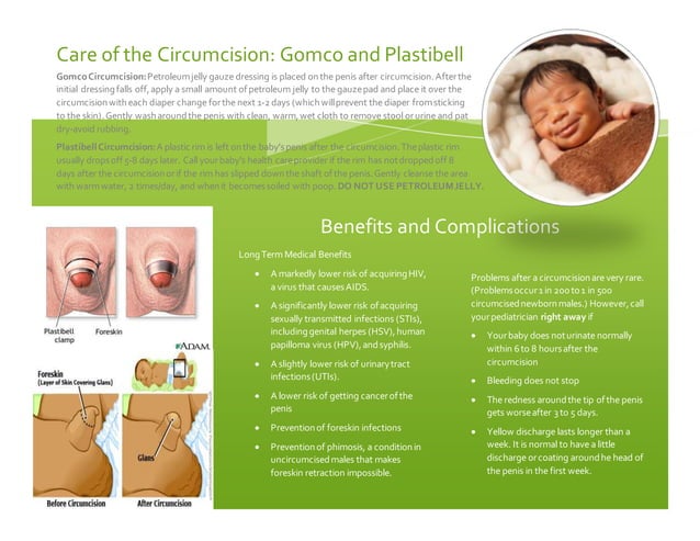 care of circumcised infant | PPT