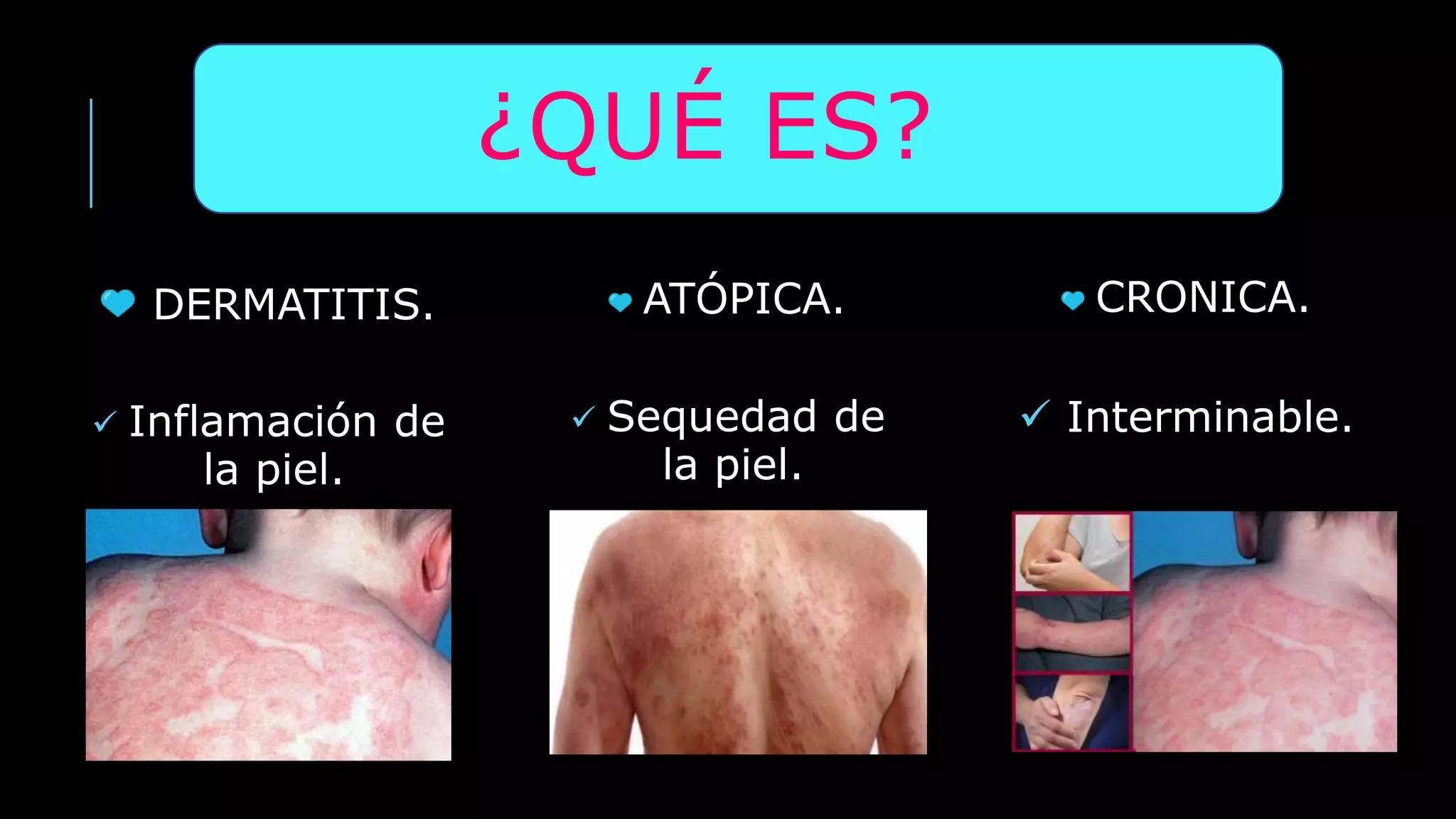 Dermatitis Atópica Crónica | PPTX