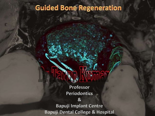 Bone Grafts | PDF