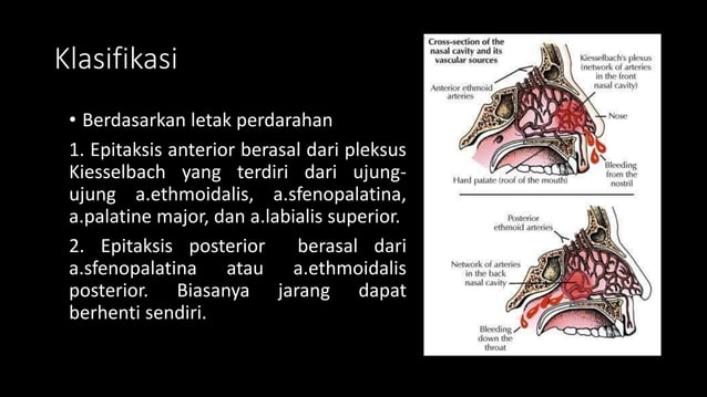 Epistaksis posterior | PPTX