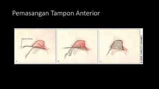 Epistaksis posterior | PPTX