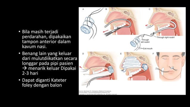 Epistaksis posterior | PPTX