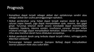 Epistaksis posterior | PPTX