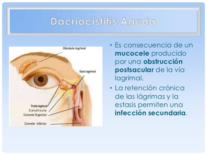 Dacriocistitis aguda