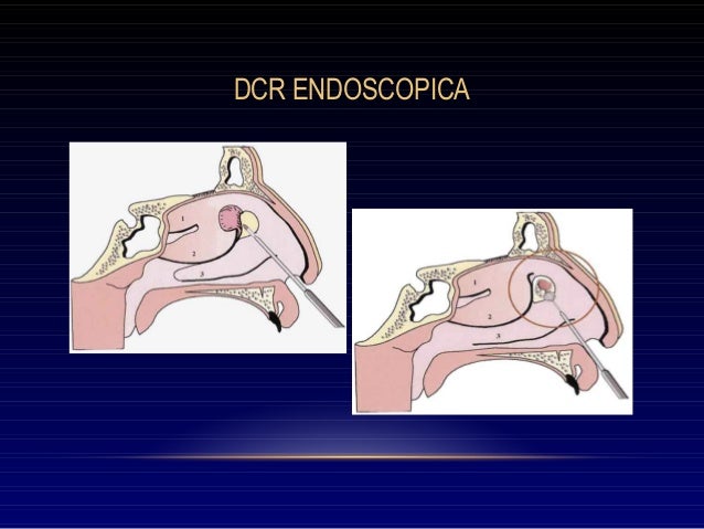 Dacriocistorrinostomia endoscopica