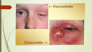 Dacroadenitis | PPTX