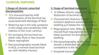 Dacrocystectomy And Dacryocystorhinostomy presentation | PPT