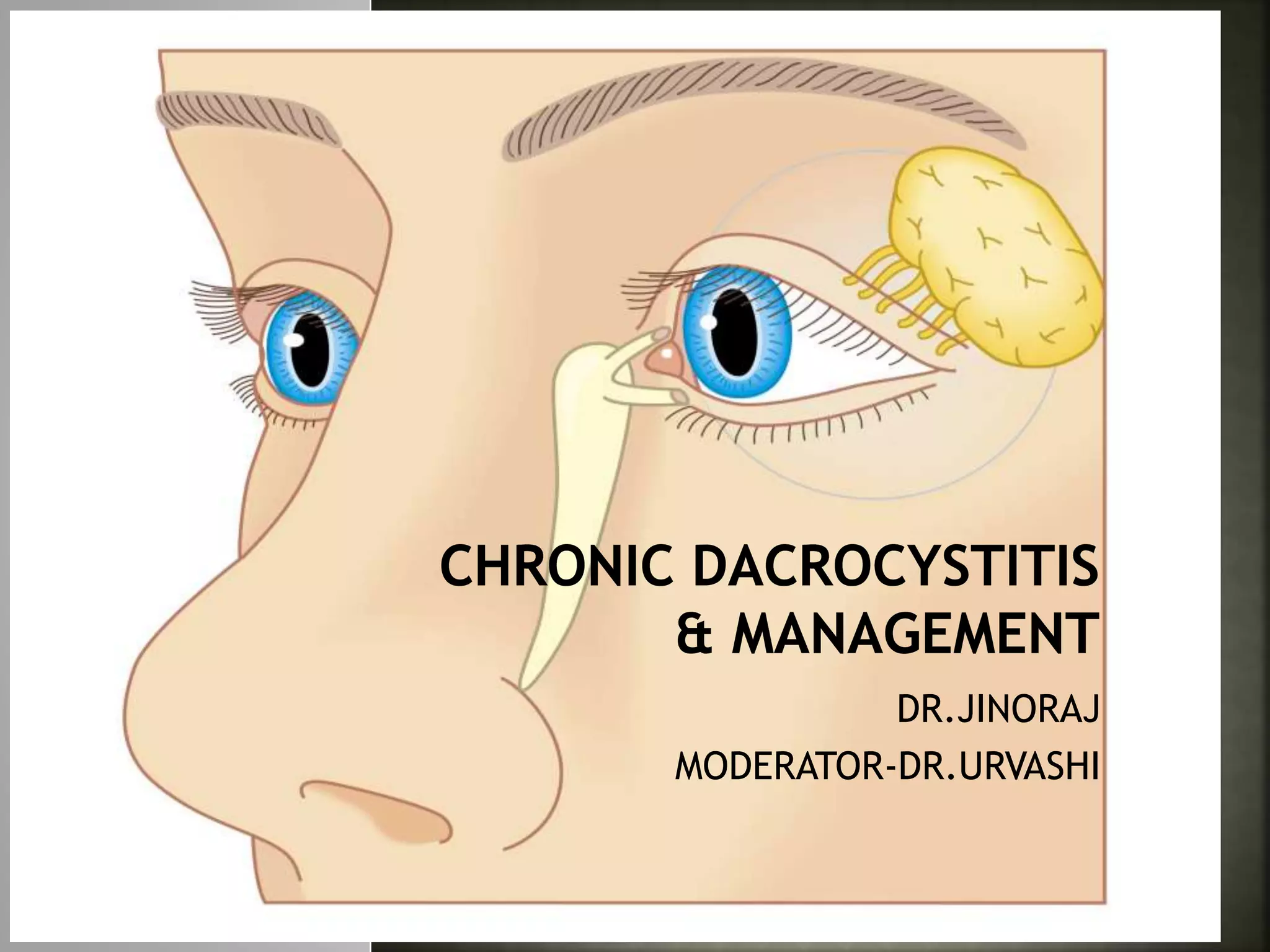 CHRONIC DACROCYSTITIS AND ITS MANAGEMENT | PPTX