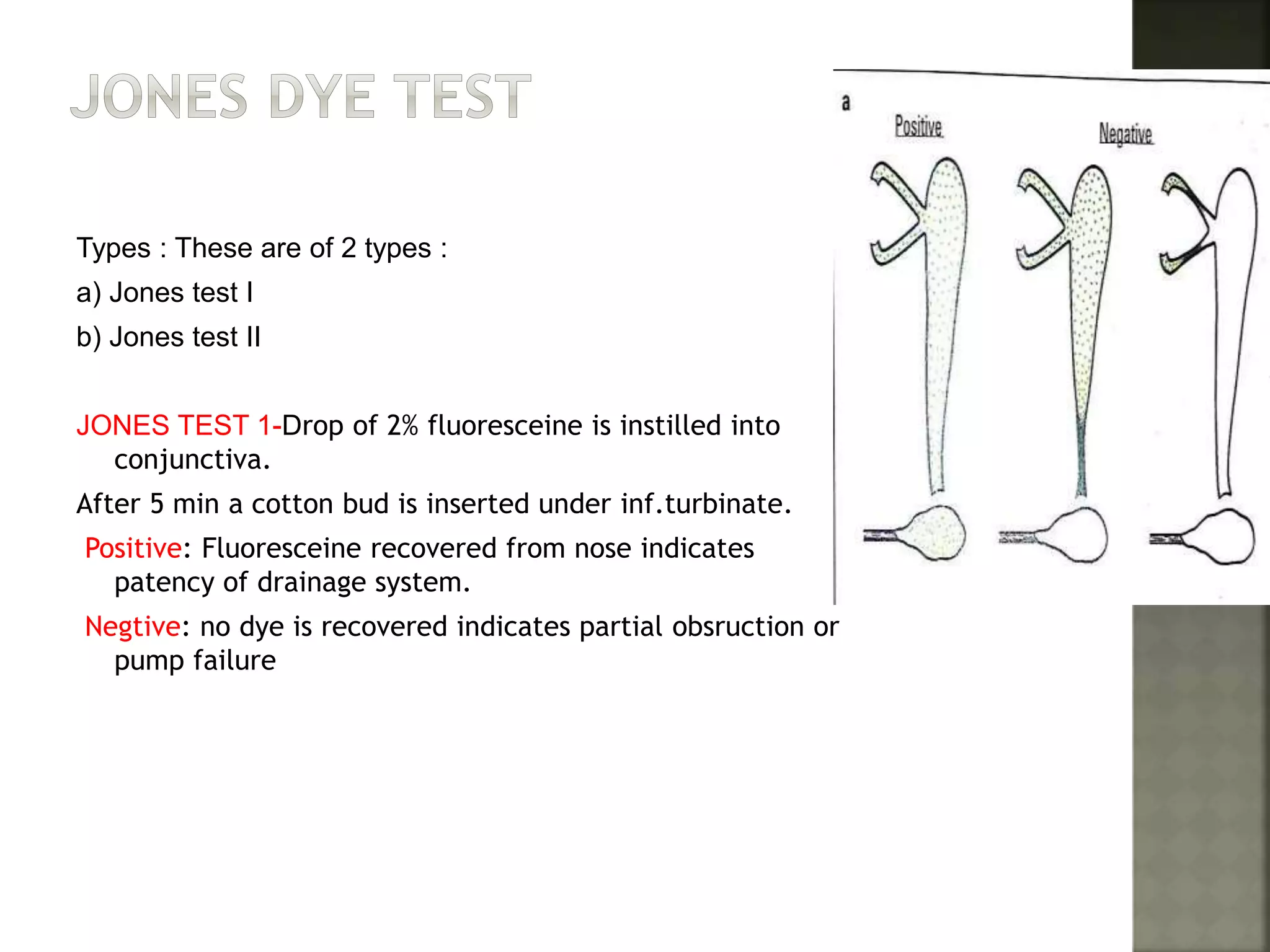 CHRONIC DACROCYSTITIS AND ITS MANAGEMENT | PPTX