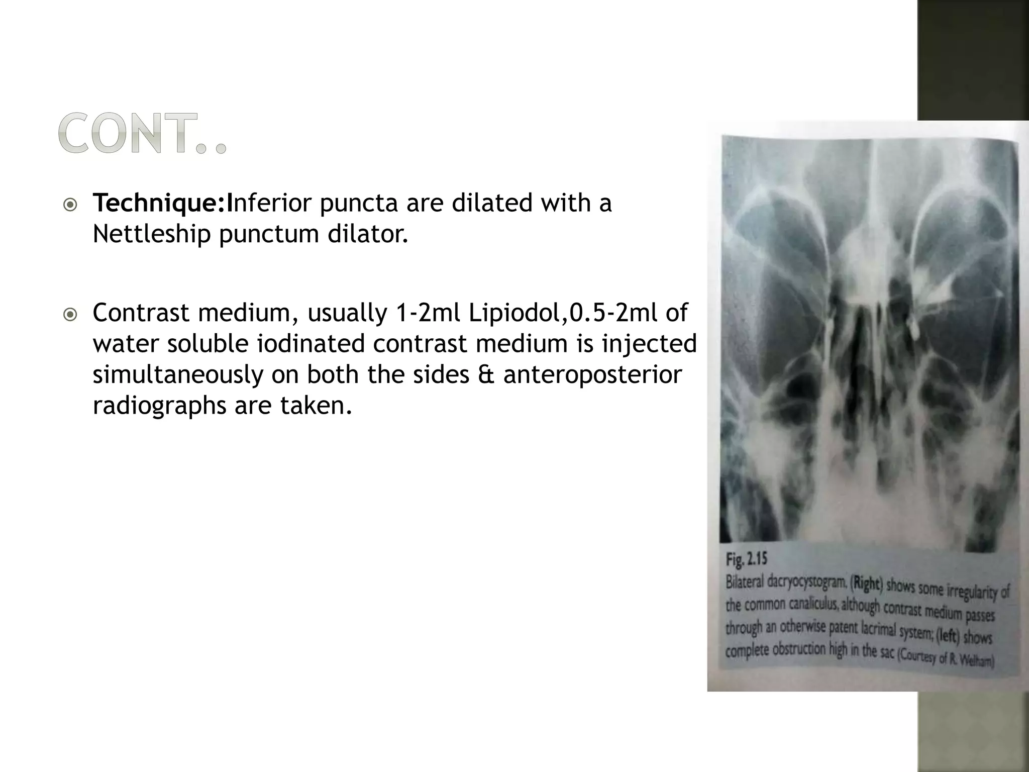 CHRONIC DACROCYSTITIS AND ITS MANAGEMENT | PPTX