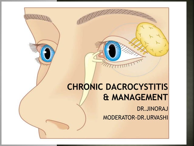 CHRONIC DACROCYSTITIS AND ITS MANAGEMENT | PPTX