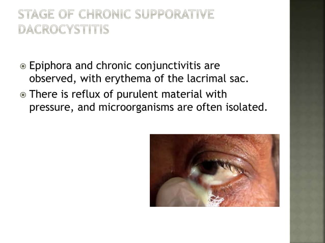 CHRONIC DACROCYSTITIS AND ITS MANAGEMENT | PPTX