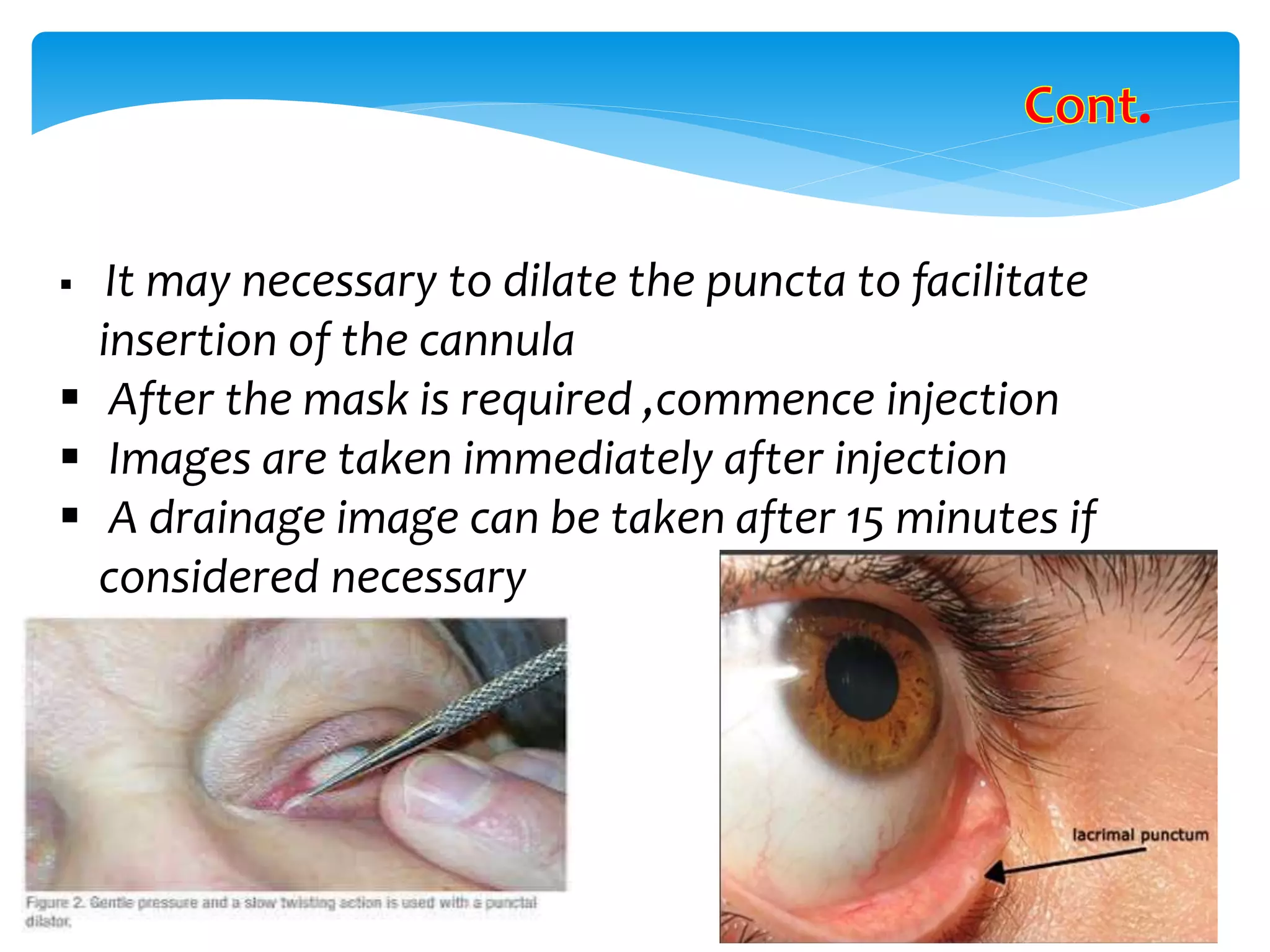 Dacrocystography | PPTX