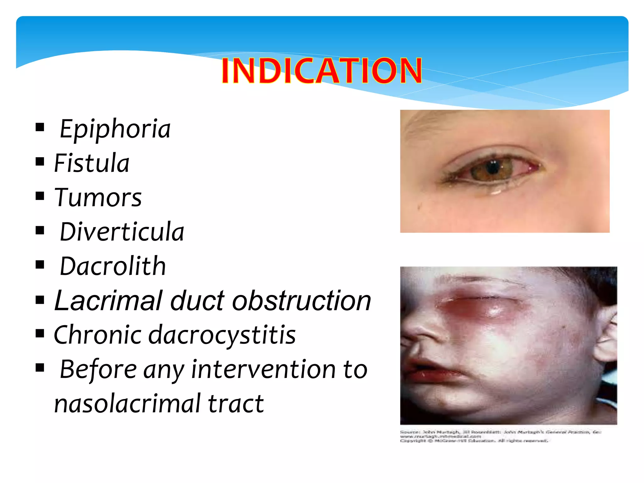 Dacrocystography | PPTX