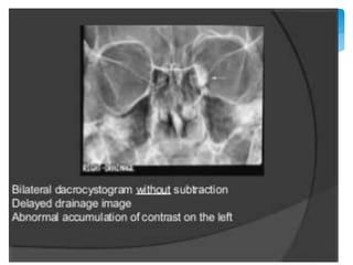 Dacrocystography | PPTX