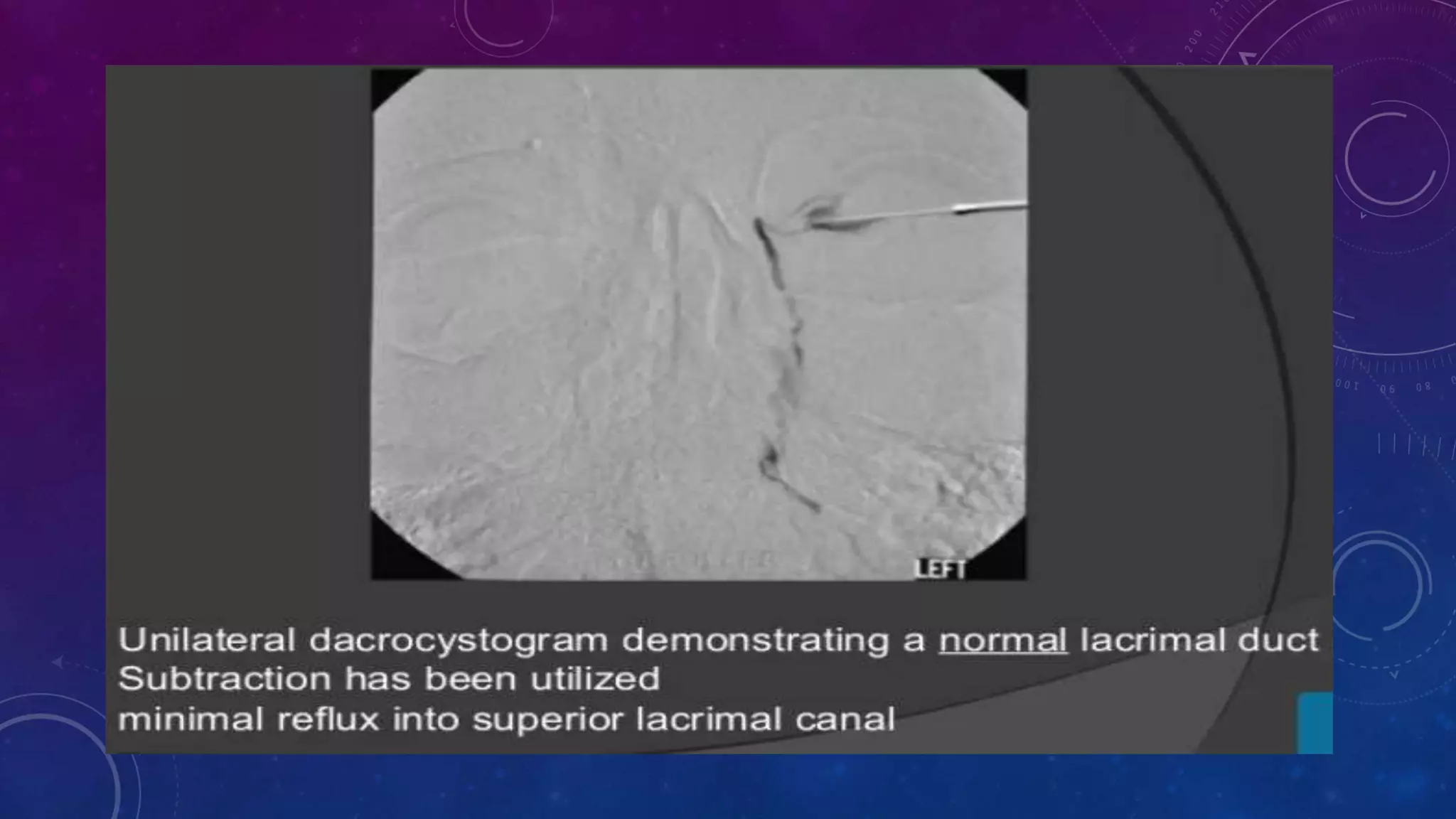 Dacrocystography.pptx