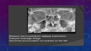 Dacrocystography.pptx