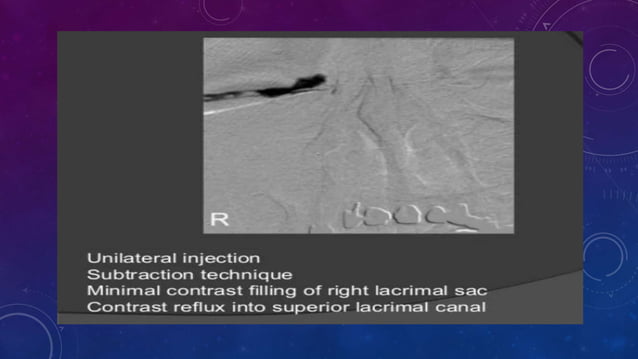 Dacrocystography.pptx | Eye and Vision Conditions | Diseases and Conditions