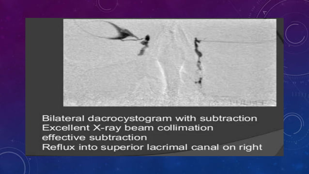 Dacrocystography.pptx | Eye and Vision Conditions | Diseases and Conditions