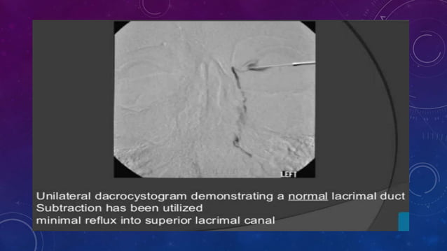 Dacrocystography.pptx | Eye and Vision Conditions | Diseases and Conditions