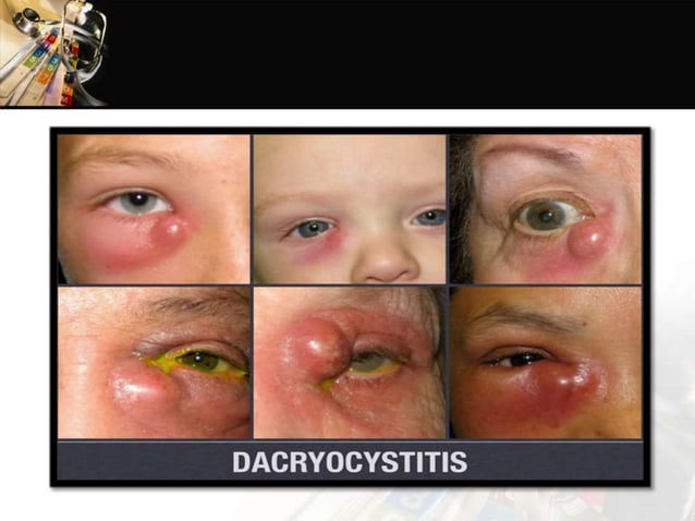 Dacryocystitis | PPTX | Ear, Nose and Throat Conditions | Diseases and ...