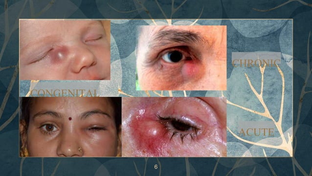 Dacryocystitis | PPTX