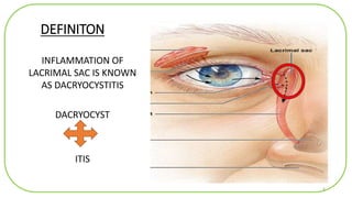 Dacryocystitis with medical and surgical management | PDF