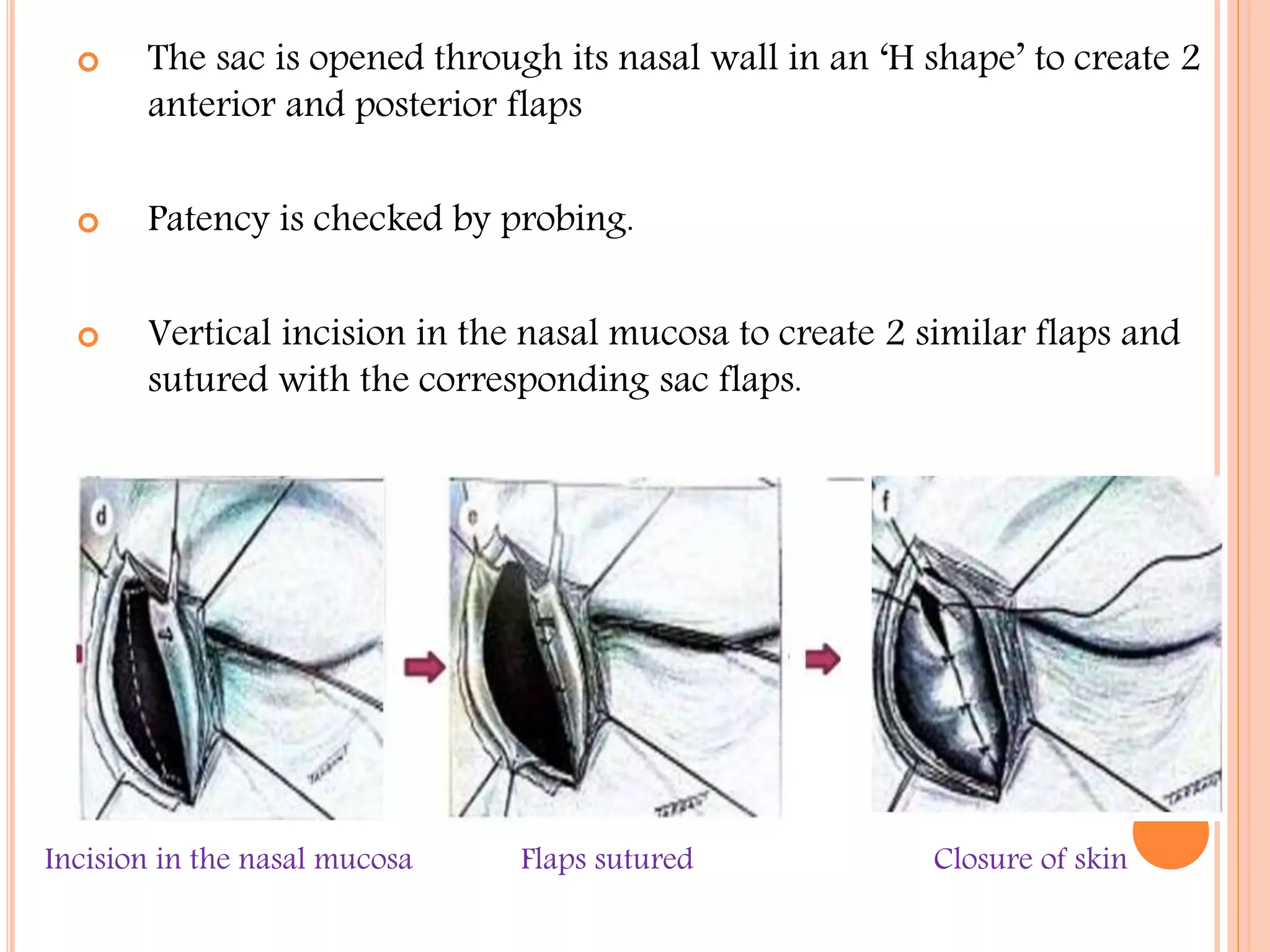 Dacryocystorhinostomy | PPTX