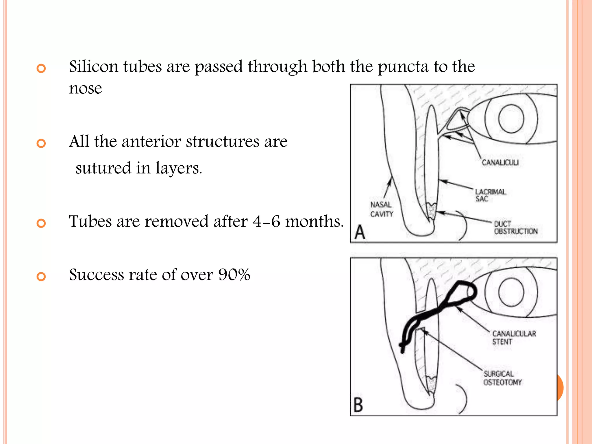 Dacryocystorhinostomy | PPTX