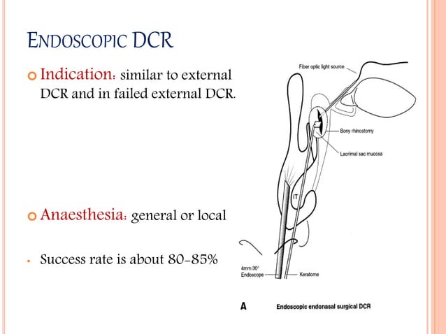 Dacryocystorhinostomy | PPTX