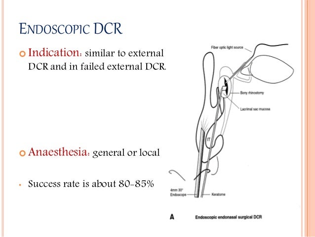 Dacryocystorhinostomy