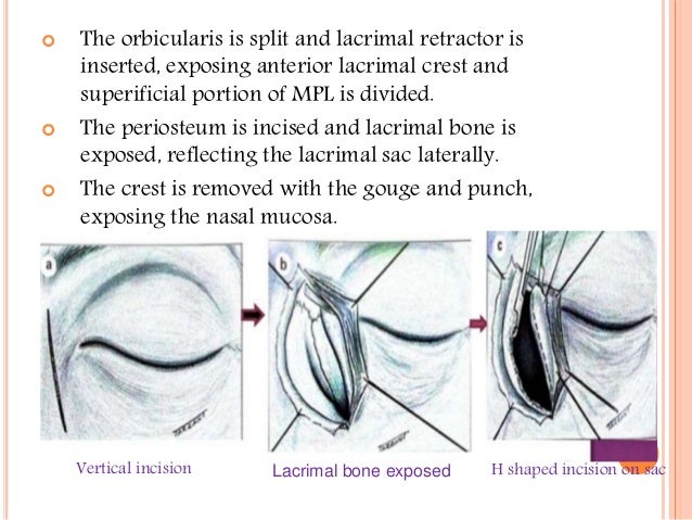 Dacryocystorhinostomy