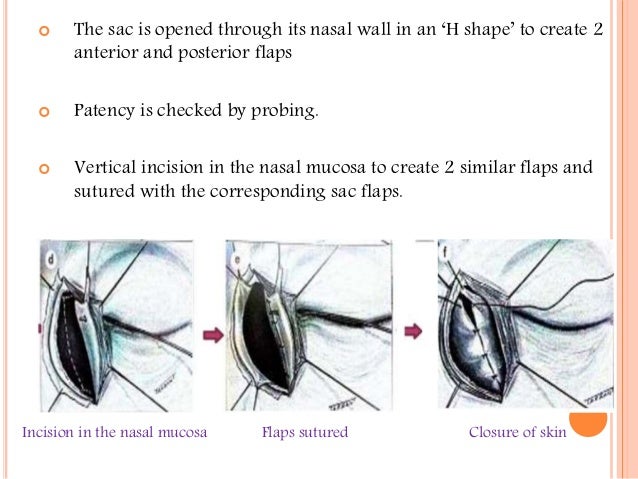 Dacryocystorhinostomy