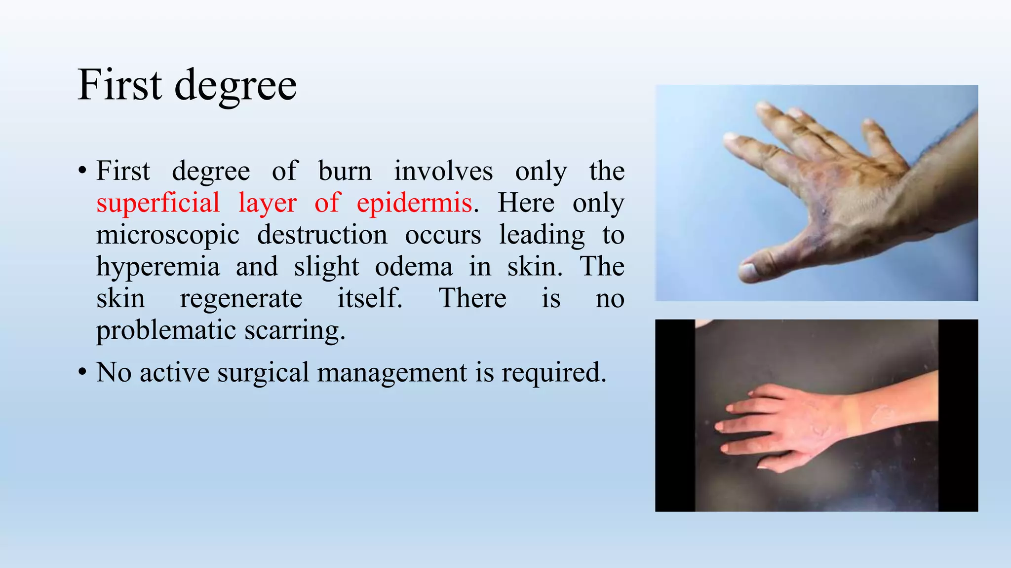 Burn Injury classification and management | PPTX