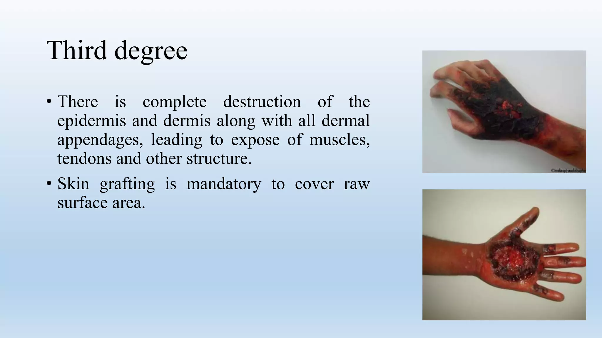 Burn Injury classification and management | PPTX