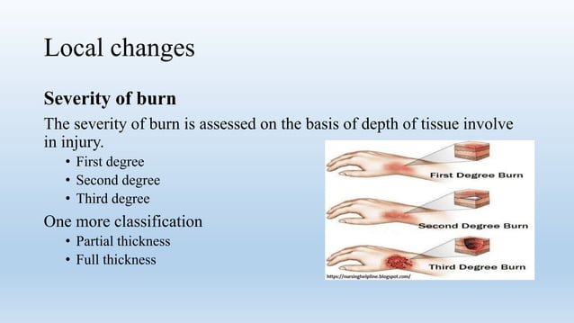Burn Injury classification and management | PPTX | First Aid | Injuries