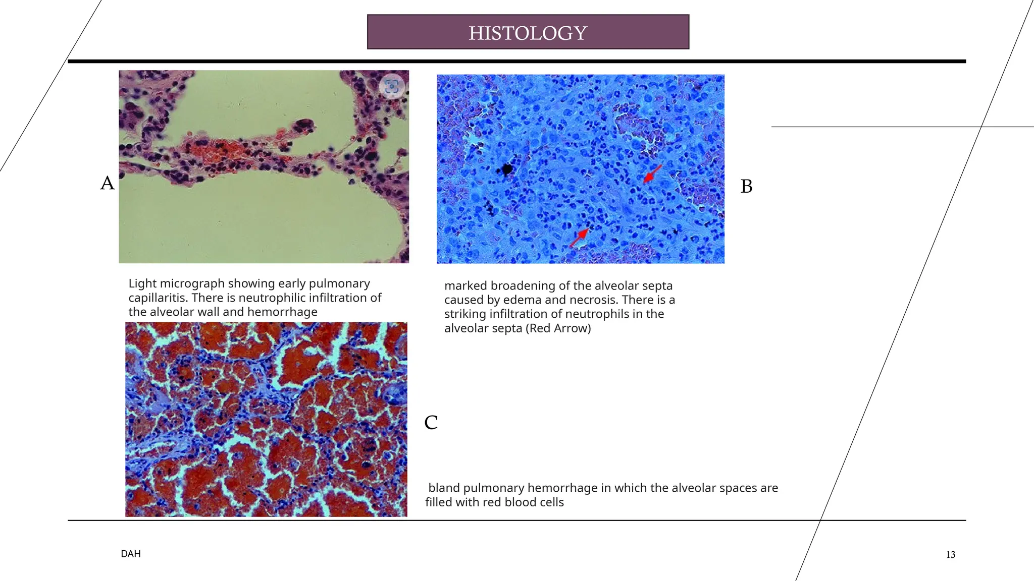 Diffuse Alveolar Hemorrhage and Vasculitis: Pulmonary Renal Syndrome ...