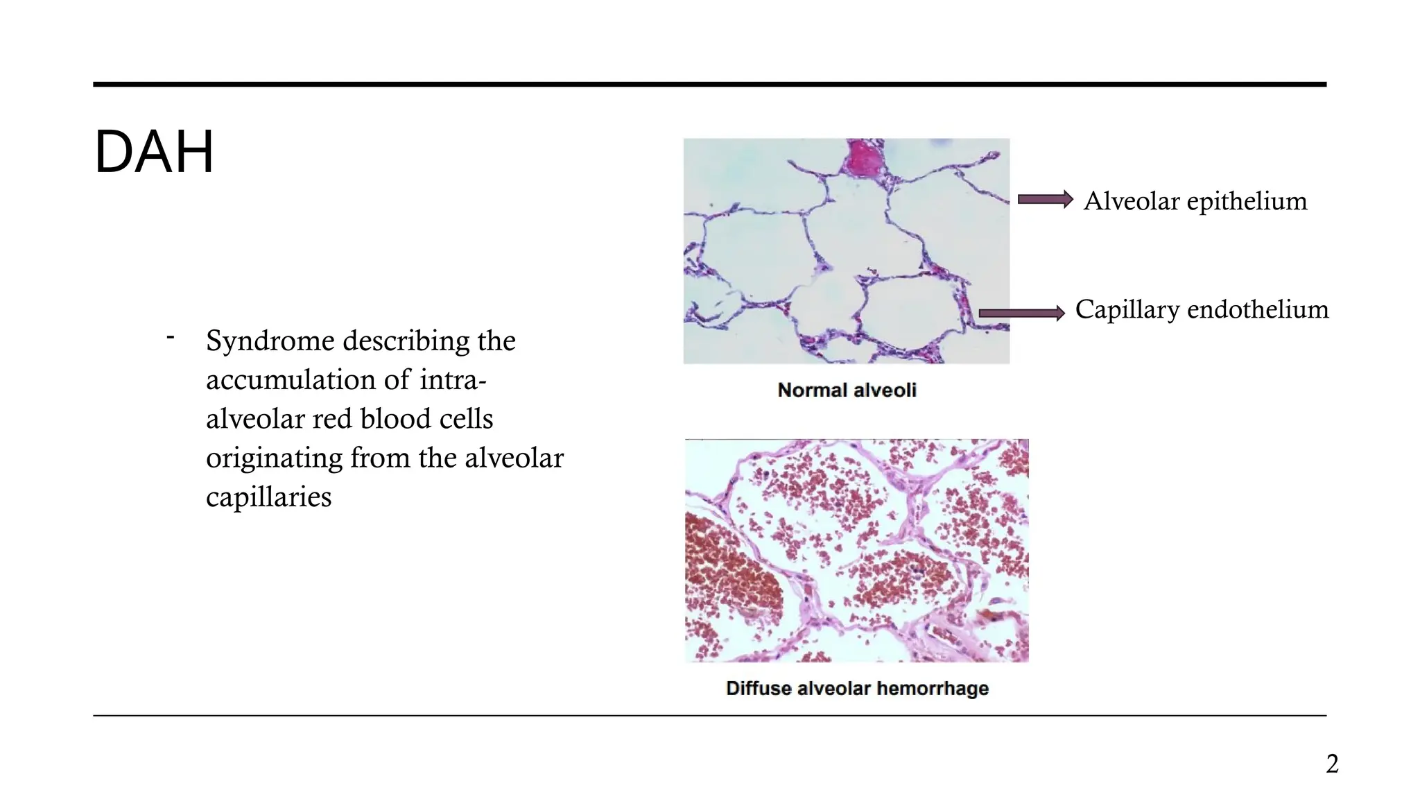 Diffuse Alveolar Hemorrhage and Vasculitis: Pulmonary Renal Syndrome ...