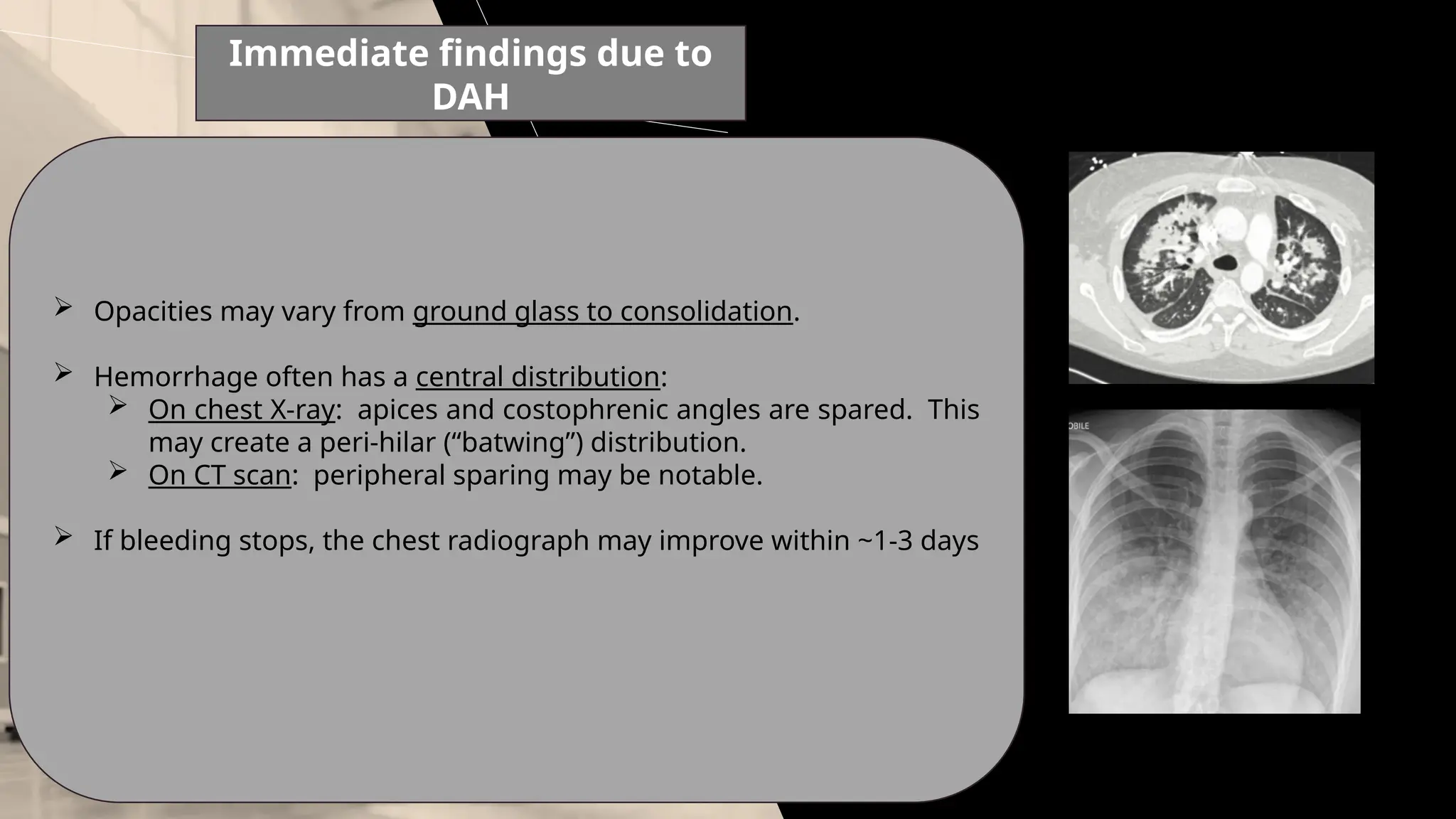 Diffuse Alveolar Hemorrhage and Vasculitis: Pulmonary Renal Syndrome ...