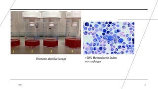 Diffuse Alveolar Hemorrhage and Vasculitis: Pulmonary Renal Syndrome ...