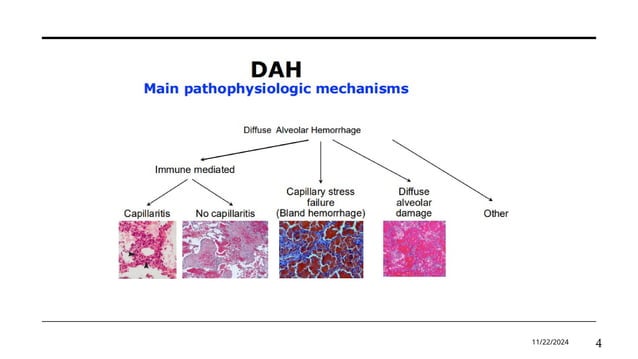 Diffuse Alveolar Hemorrhage and Vasculitis: Pulmonary Renal Syndrome ...
