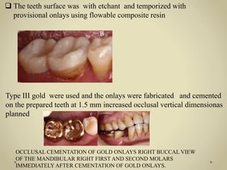 DAHL APPROACH a novel technique to raise bite | PPTX
